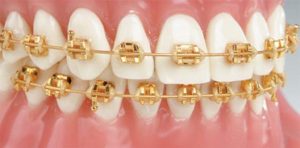 Orthodontist in Davenport, FL | Gold Braces