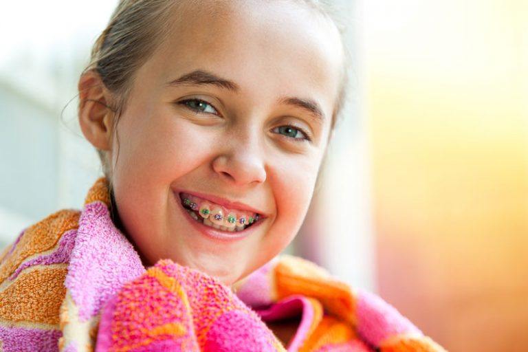 Mini Metal Braces | Orthodontist in Davenport & Celebration, FL
