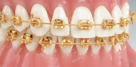 Gold Braces | Orthodontist in Davenport & Celebration, FL